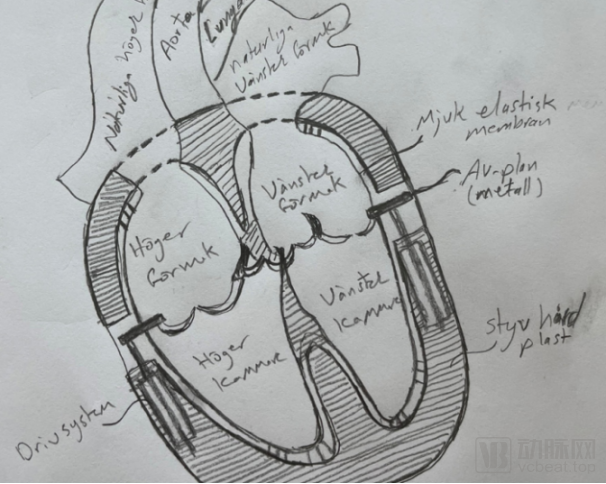 Real Heart：瑞典全人工心脏如何闯关心衰最后一公里？-36氪
