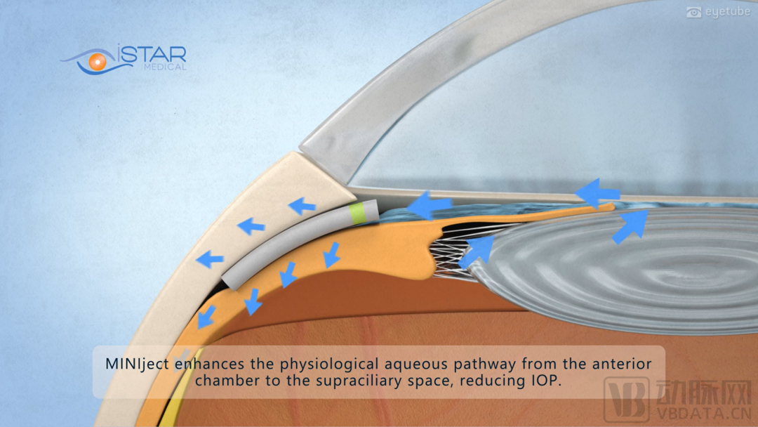 眼科巨头争相投入超50亿元，这一赛道为何突然爆火？-36氪