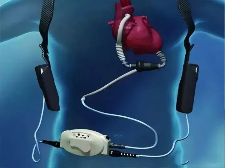 没有心跳也能正常生活，国产全磁悬浮人工心脏，到底有多神奇？-36氪