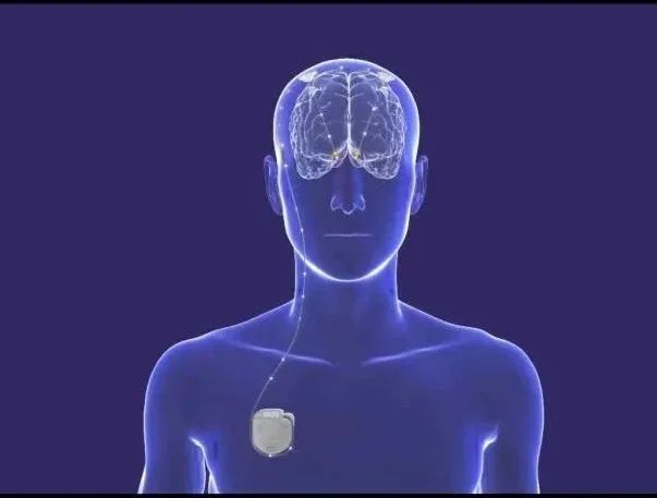 世界首例，中国90后在脑中植入机器，一打开就变快乐了-36氪