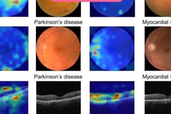 160w+ 未标注图像、3 个维度全方位评估，周玉坤等人开发 RETFound 模型，用视网膜图像预测多种系统性疾病-36氪
