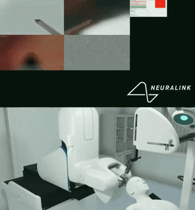 Neuralink完成首例人类脑机接口植入，还有千人正在排队｜最前线-36氪